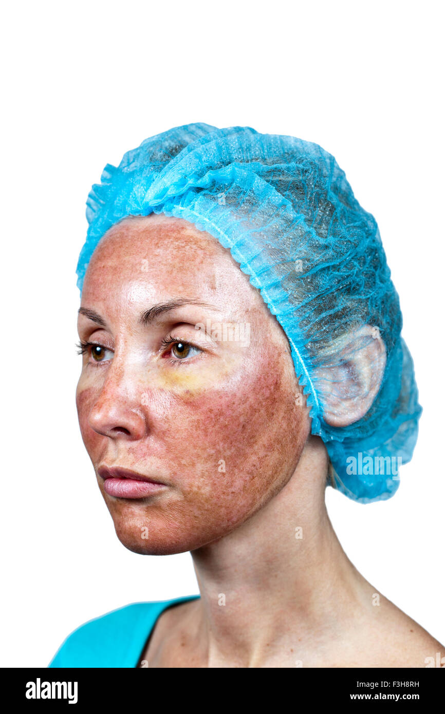 Cosmetology. New skin after a chemical peeling, a redness because of ...