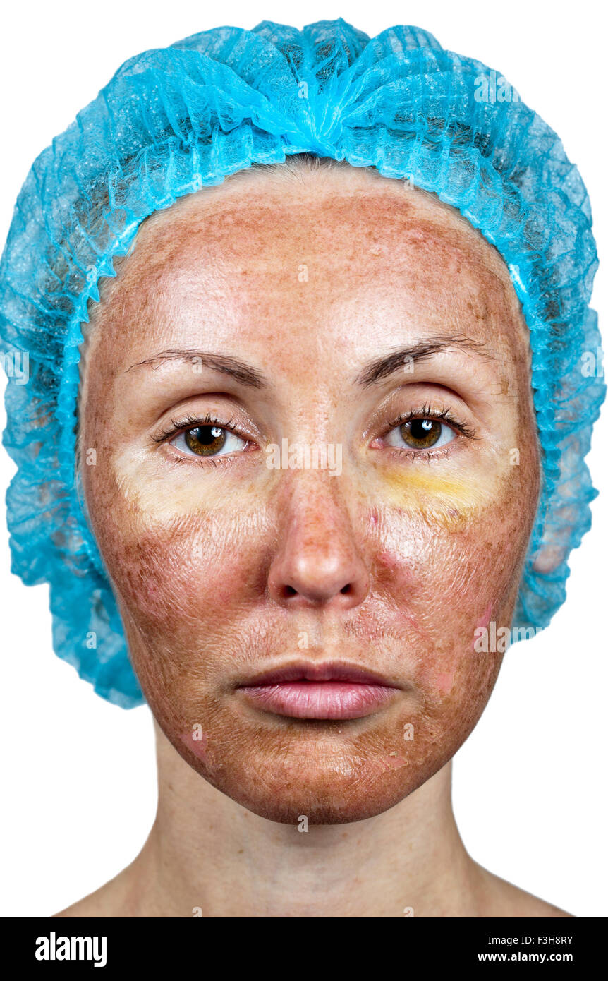 Cosmetology. New skin after a chemical peeling, a redness because of ...