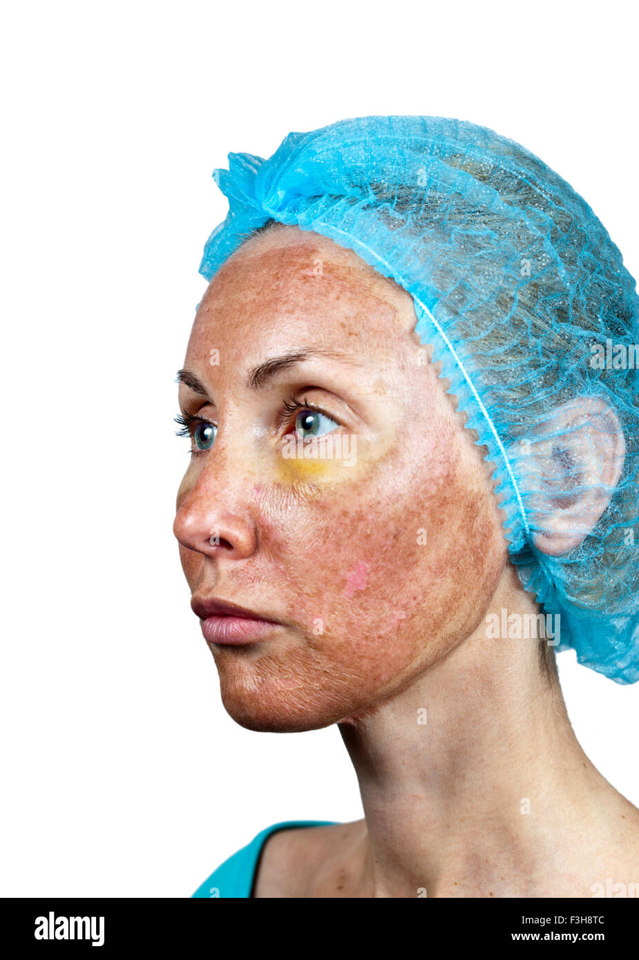 Cosmetology. New skin after a chemical peeling, a redness because of ...