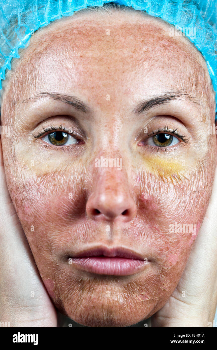 Cosmetology. New skin after a chemical peeling, a redness because of ...