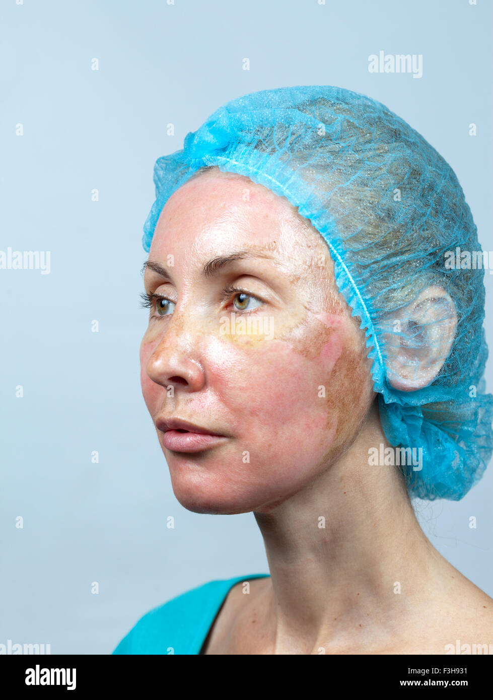Cosmetology. New skin after a chemical peeling, a redness because of ...
