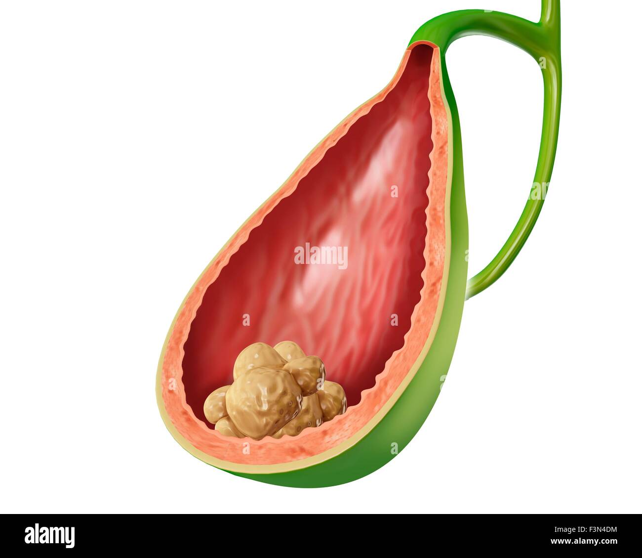 Gallstones Cut Out Stock Images & Pictures - Alamy