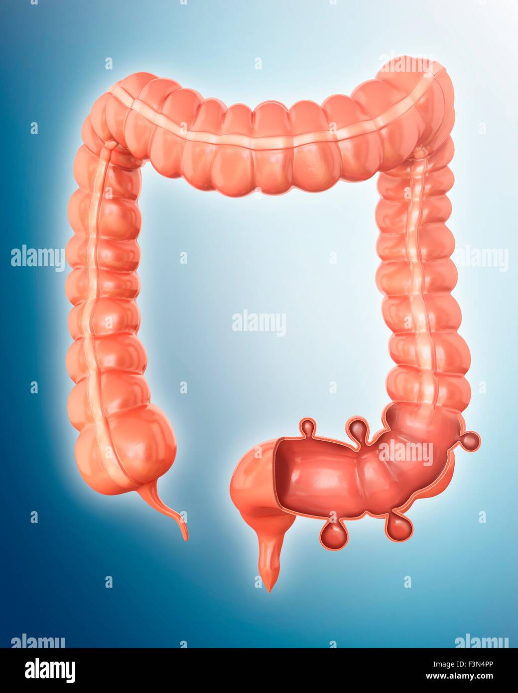 Diverticulosis artwork hi-res stock photography and images - Alamy