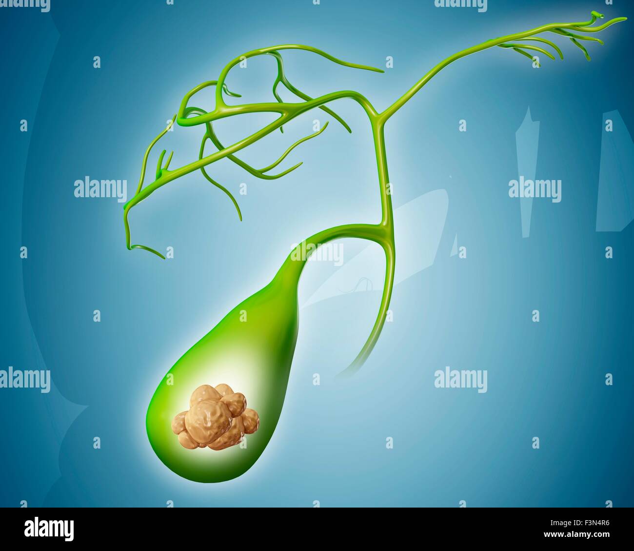 Gall stones, illustration Stock Photo - Alamy