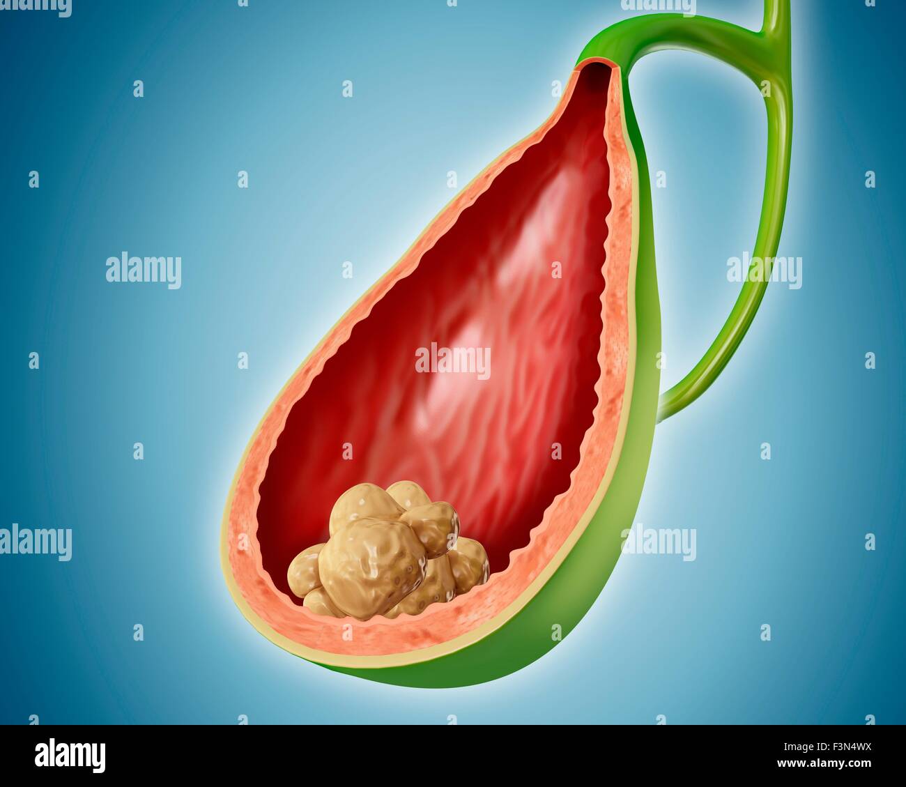 Gall stones, illustration Stock Photo - Alamy