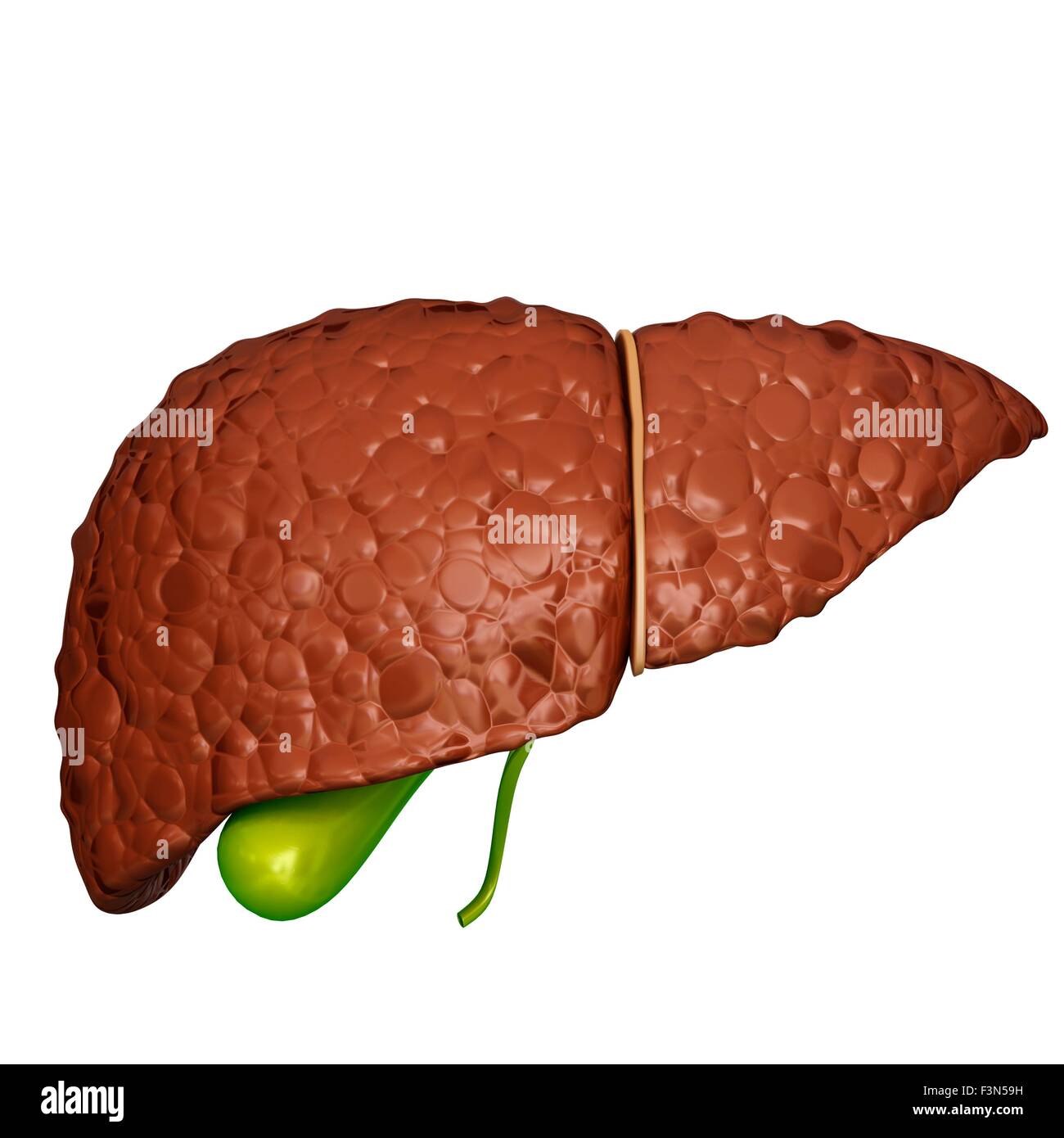 Liver cirrhosis, illustration Stock Photo - Alamy