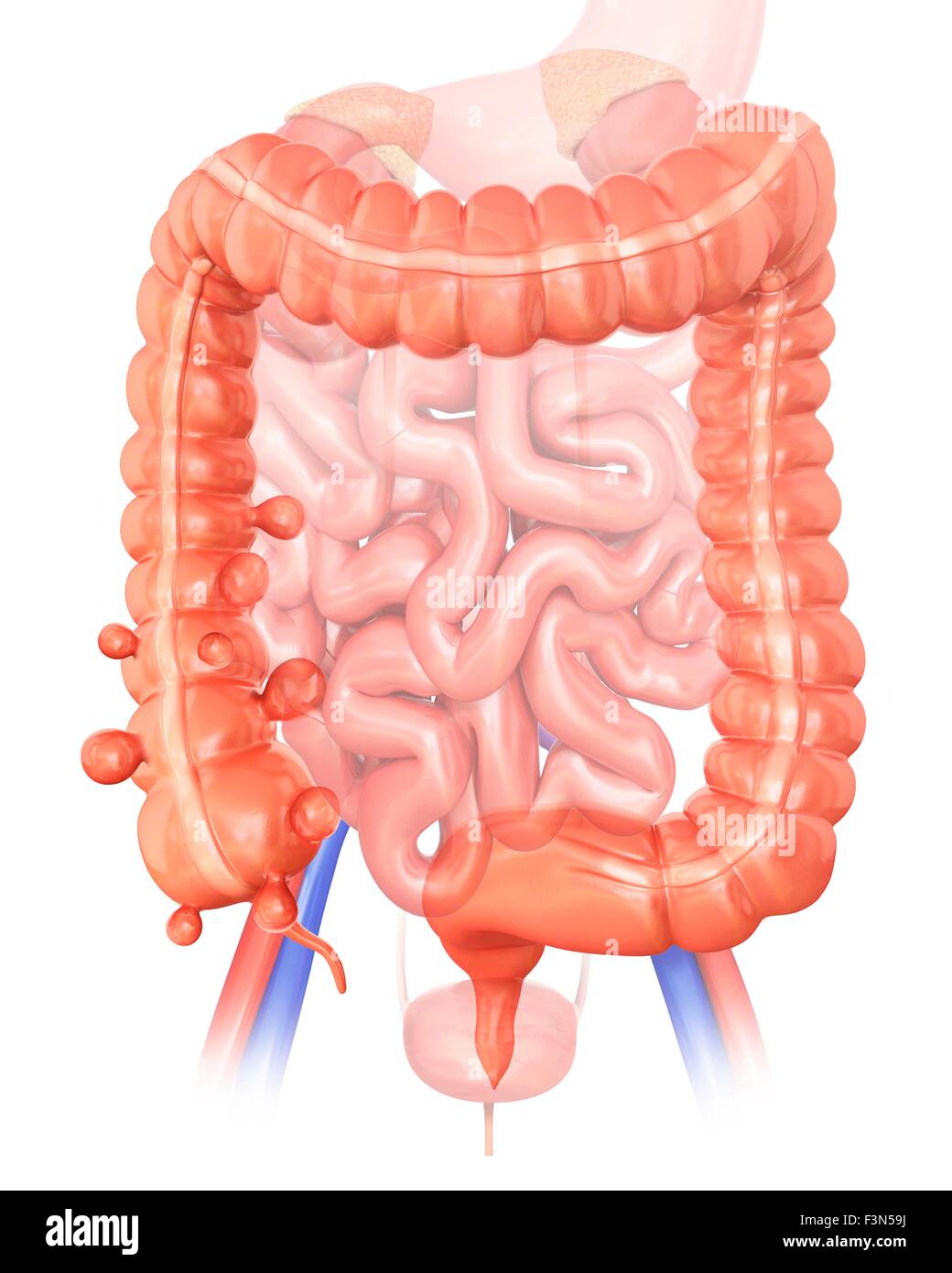 Large intestine diverticulitis Cut Out Stock Images & Pictures - Alamy