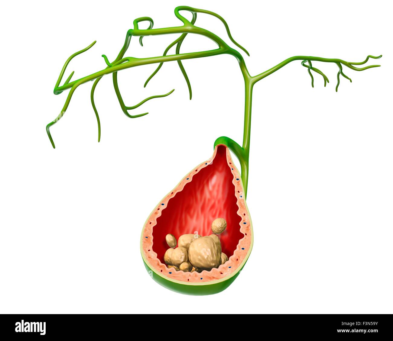 Gall stones, illustration Stock Photo - Alamy