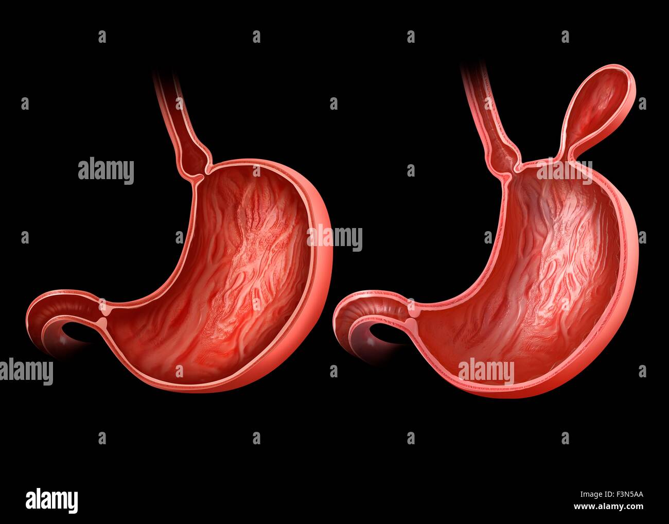 Hernia stomach hi-res stock photography and images - Alamy