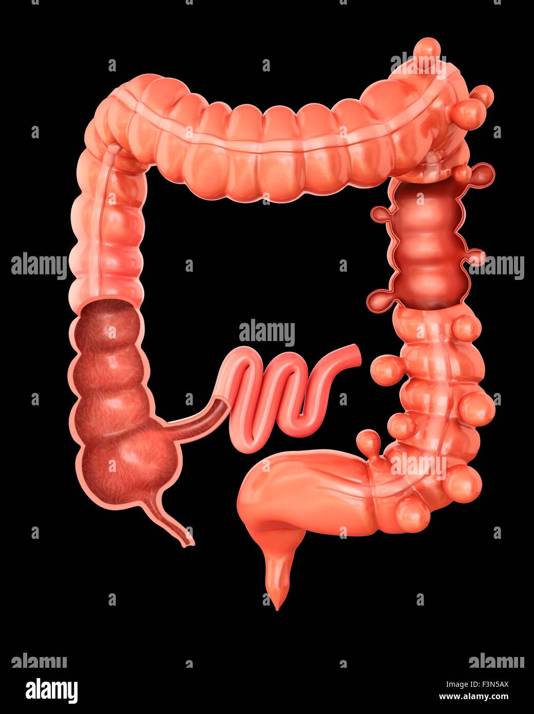 Large intestine diverticulitis hi-res stock photography and images - Alamy