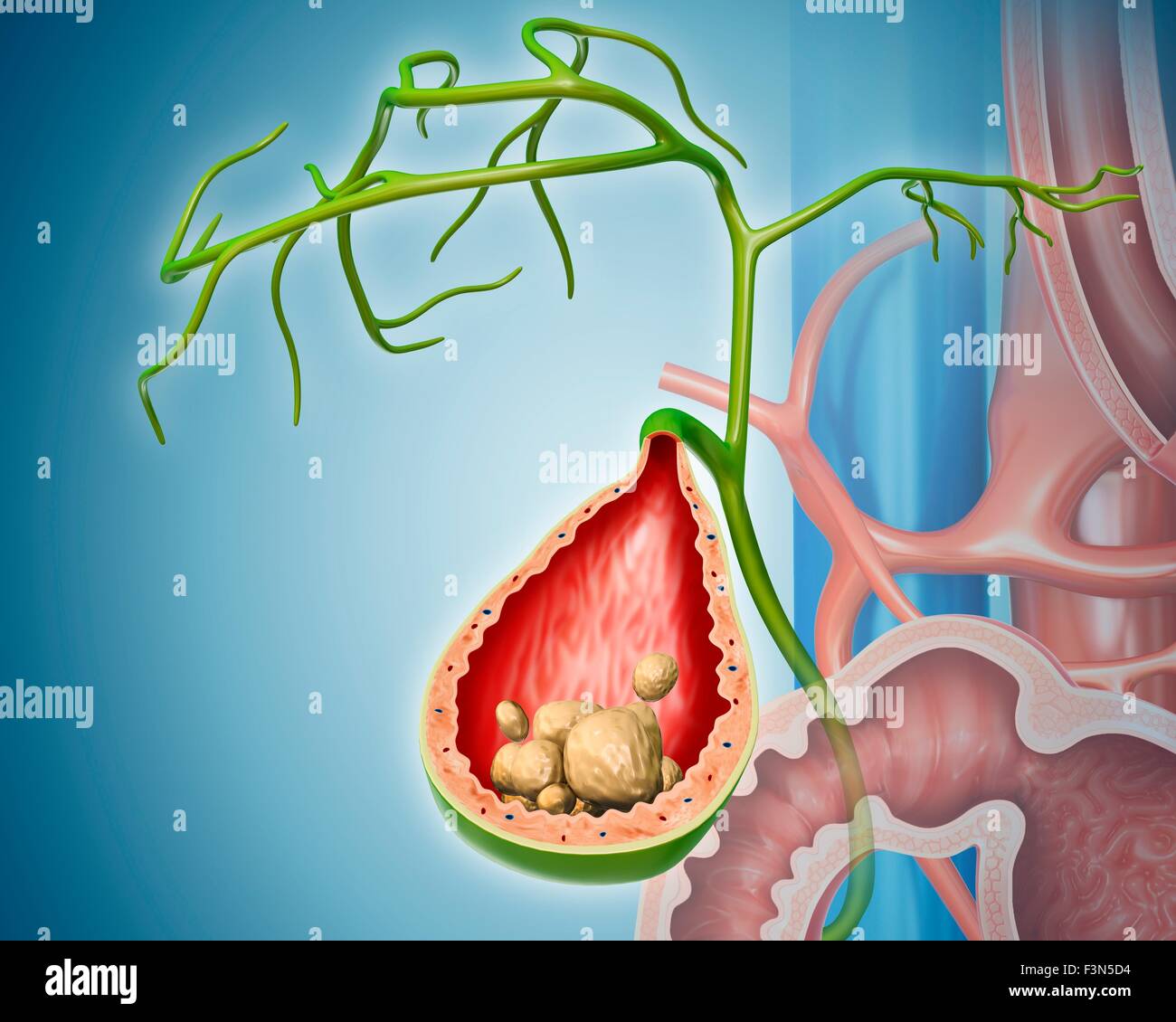 Gall stones, illustration Stock Photo - Alamy