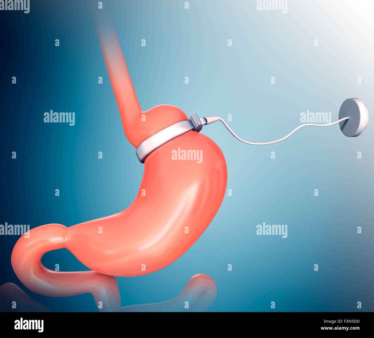 Human gastric band, illustration Stock Photo - Alamy