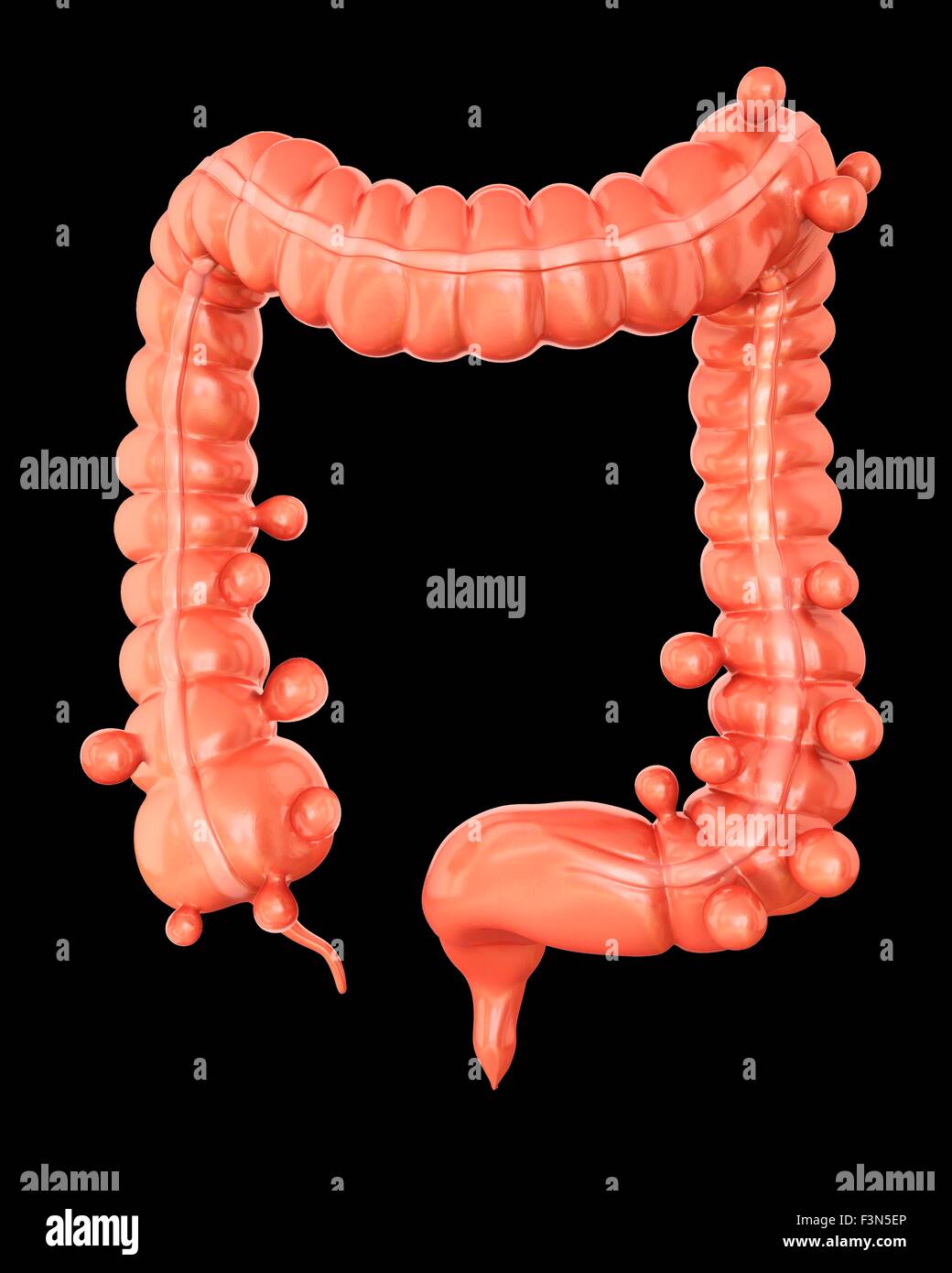 Large intestine diverticulitis hi-res stock photography and images - Alamy