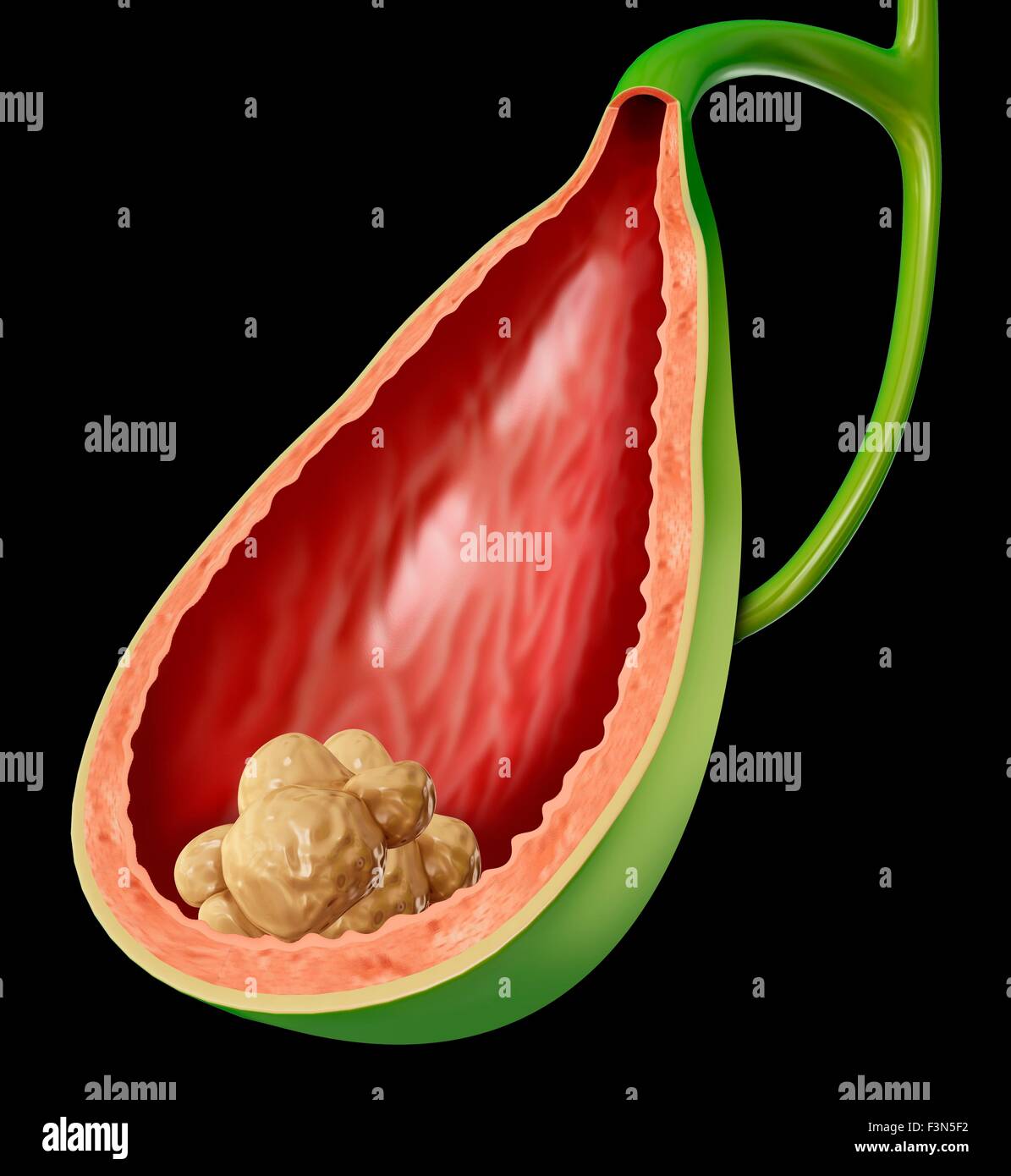 Gall stones hi-res stock photography and images - Alamy