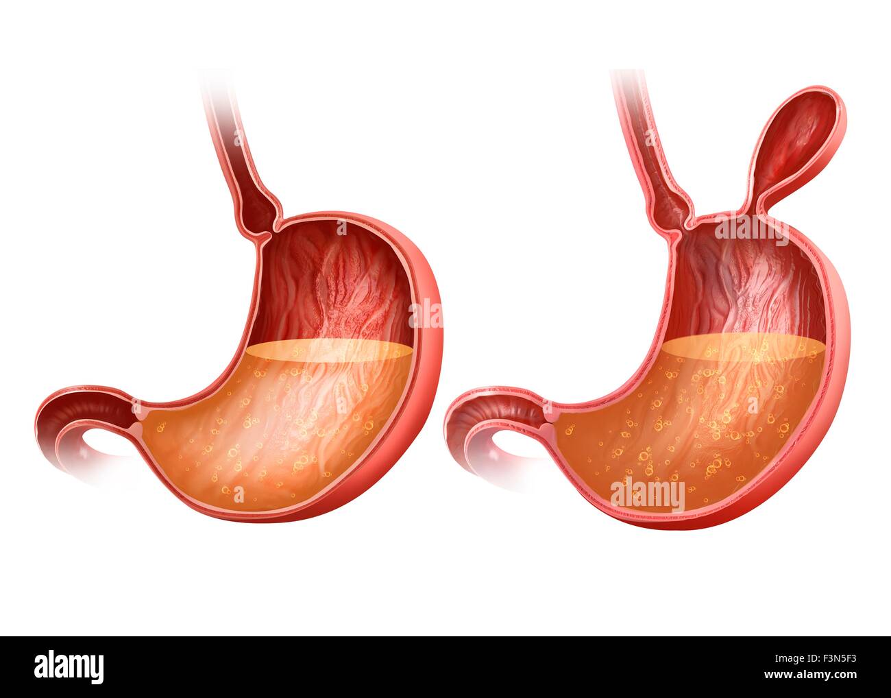 Hernia stomach hi-res stock photography and images - Alamy