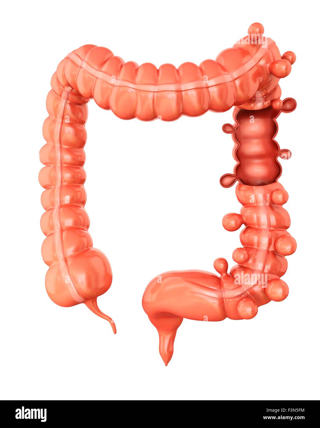 Large intestine diverticulitis hi-res stock photography and images - Alamy