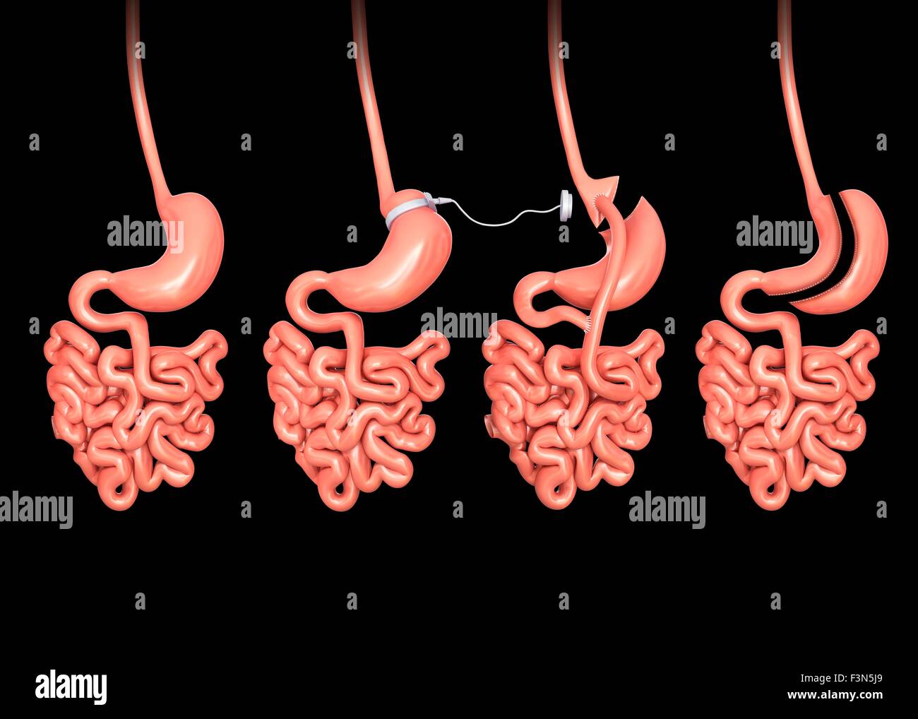 Weight loss surgery hi-res stock photography and images - Alamy