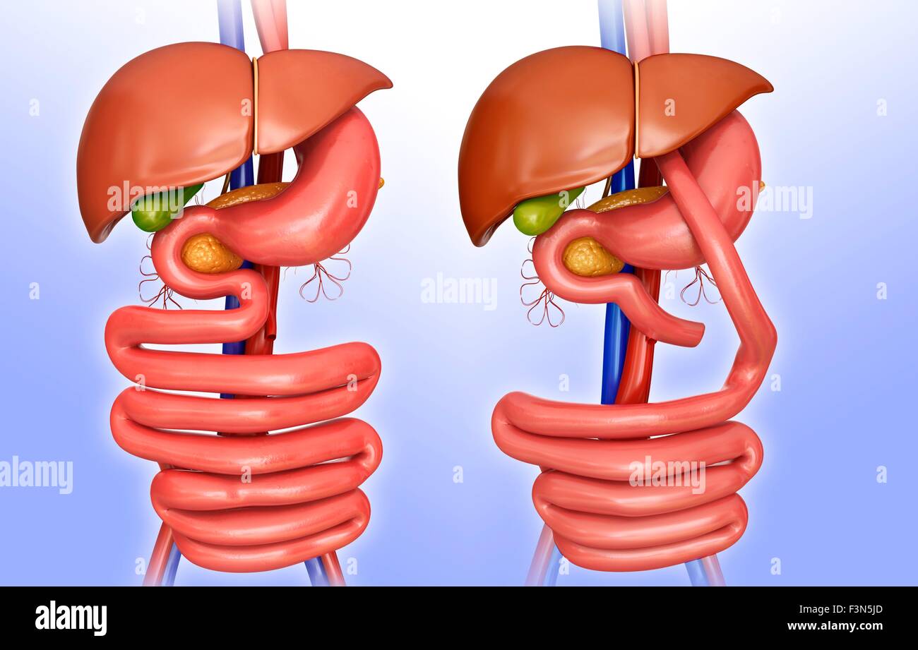 Gastric bypass, illustration Stock Photo - Alamy