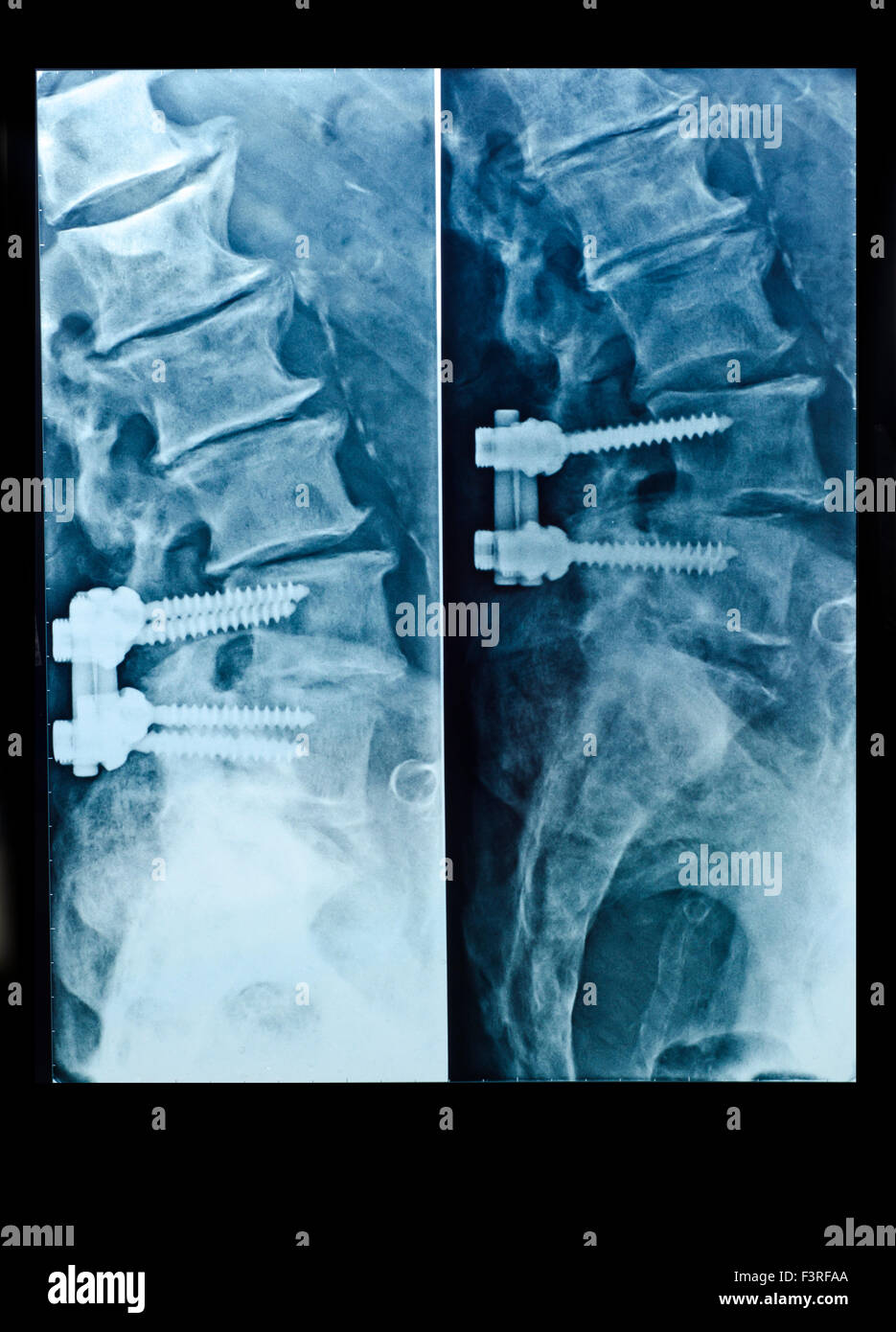 X-Ray image of spinal column with screws after surgery in man body ...