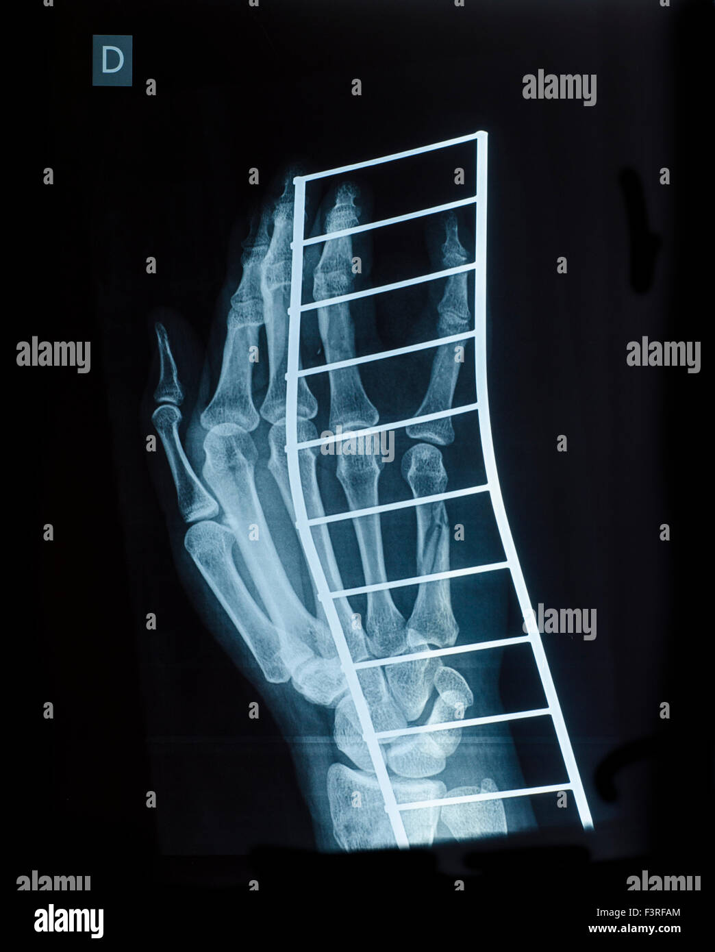 X ray normal hand hi-res stock photography and images - Alamy