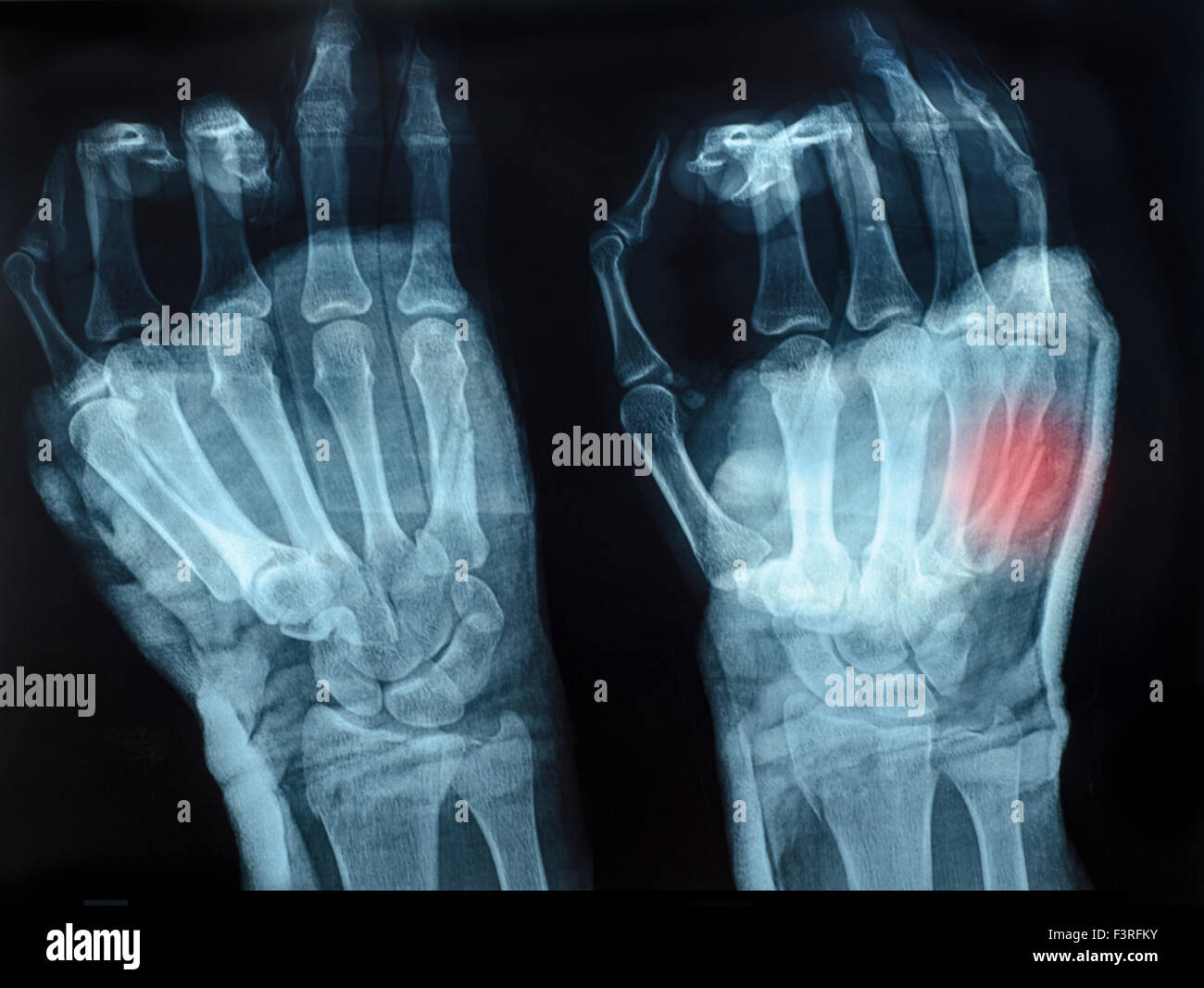 X-Ray image of human hands with top hand shown red for fracture Stock ...