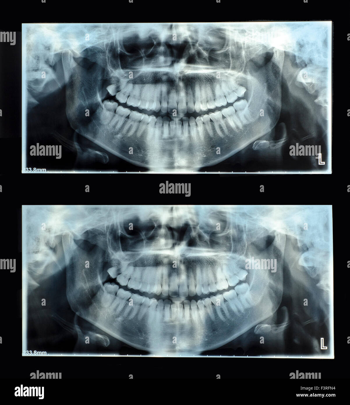 Simple panoramic dental x-ray Stock Photo - Alamy