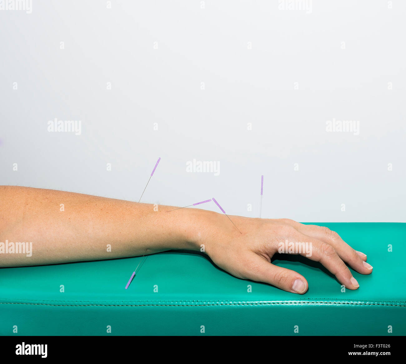 Acupuncture needle, pinched through the skin for alternative therapy ...