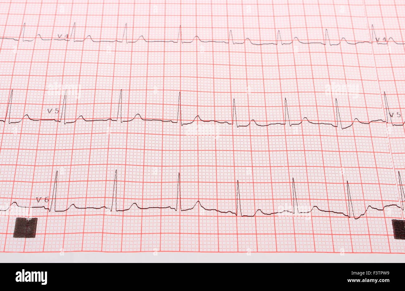 Electrocardiogram graph ekg heart rhythm, medicine concept Stock Photo ...