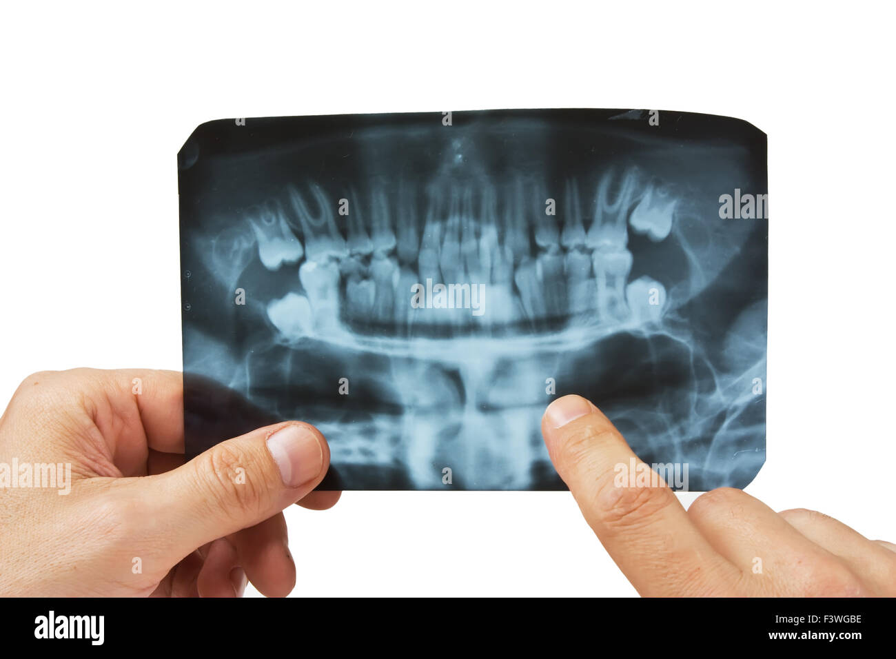 X ray radiograph hand hi-res stock photography and images - Alamy