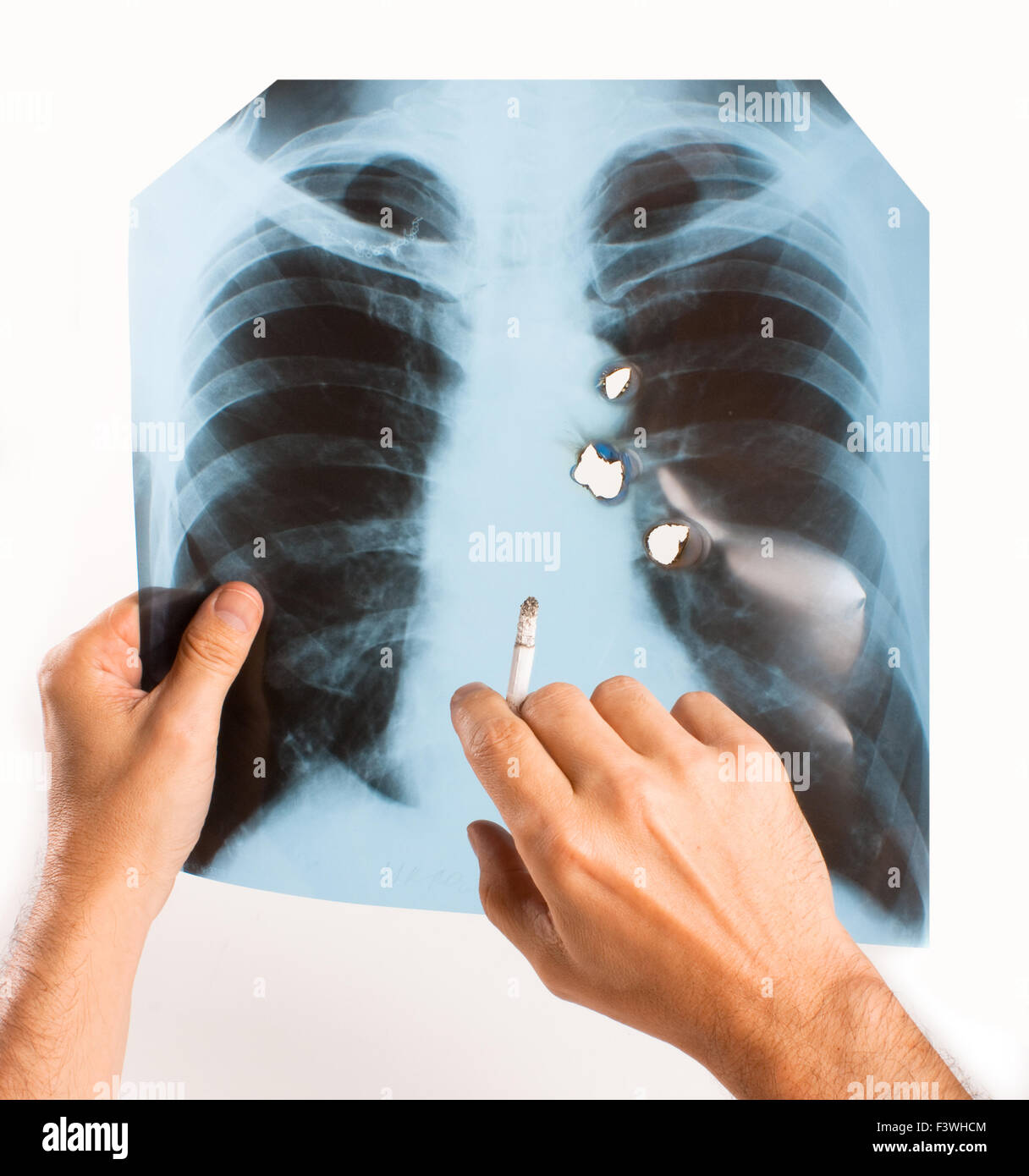 Lung x ray hi-res stock photography and images - Alamy