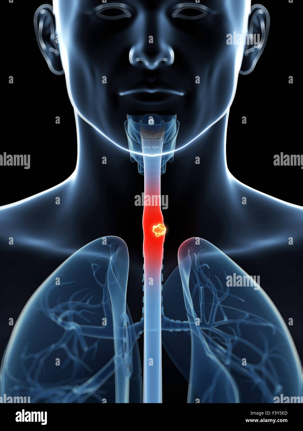 The Esophagus Canadian Cancer Society