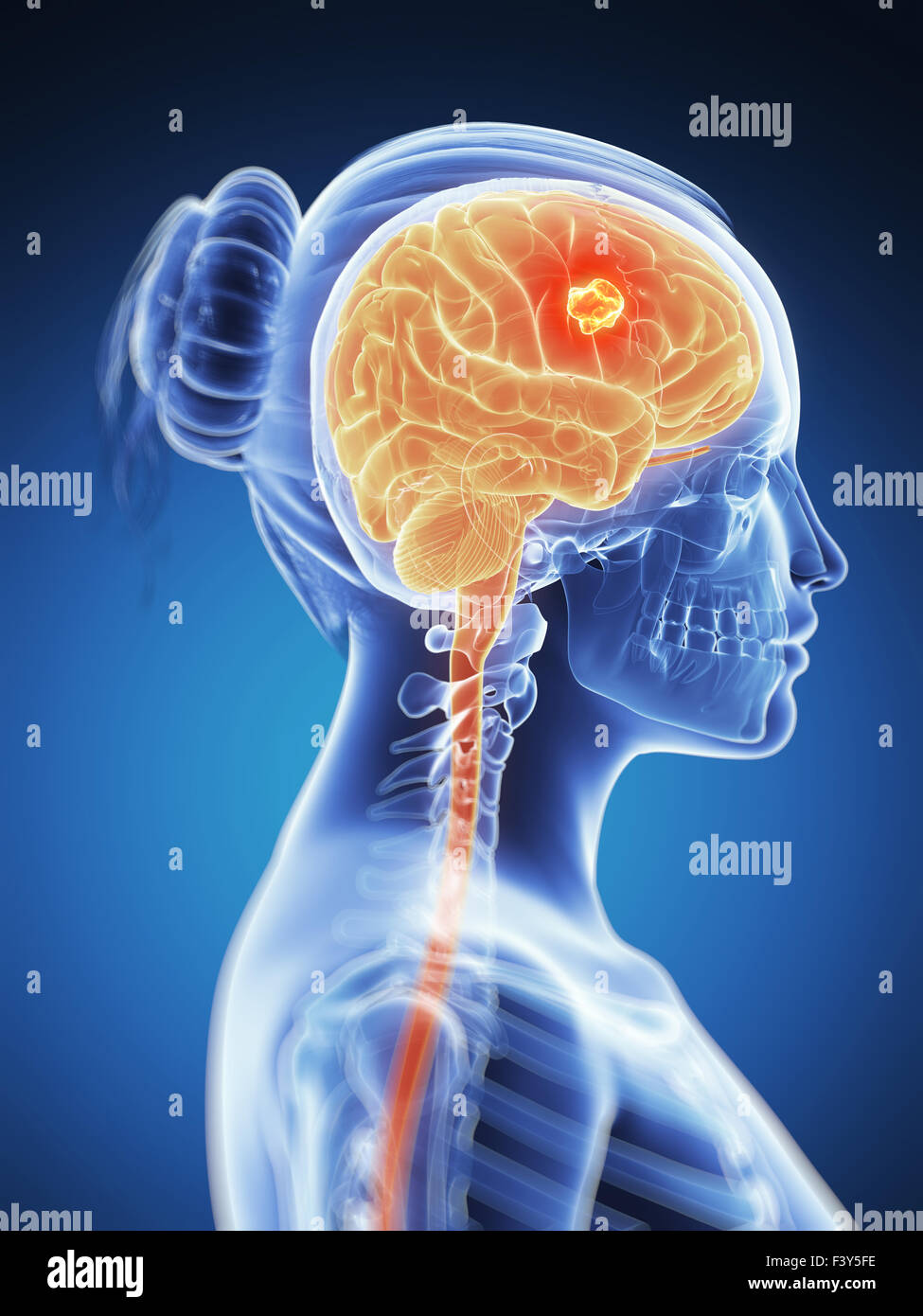 3d rendered illustration - brain cancer Stock Photo - Alamy