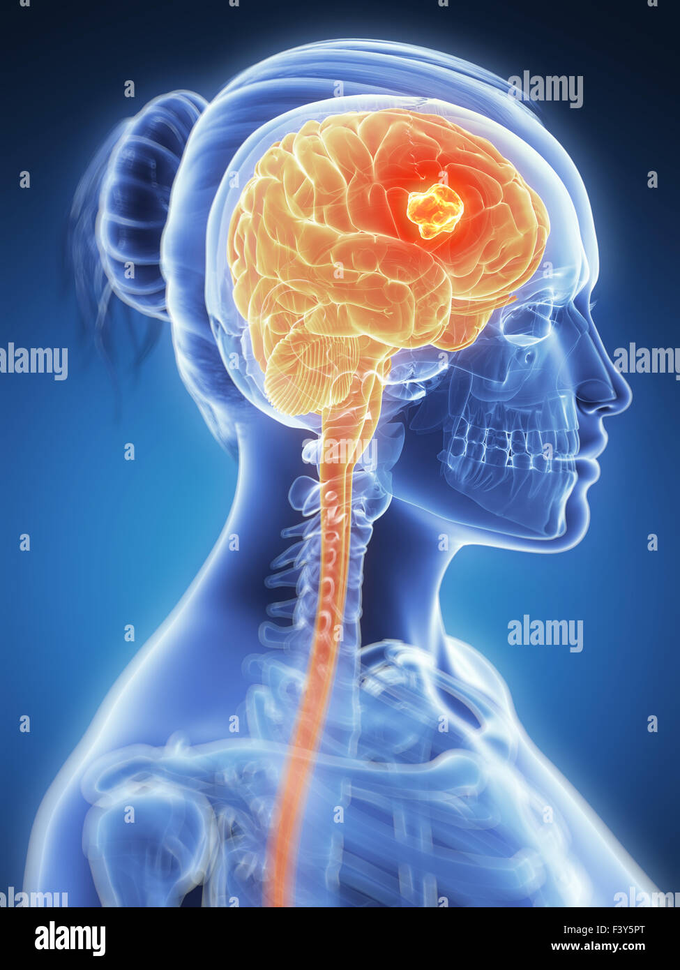 3d rendered illustration - brain cancer Stock Photo - Alamy