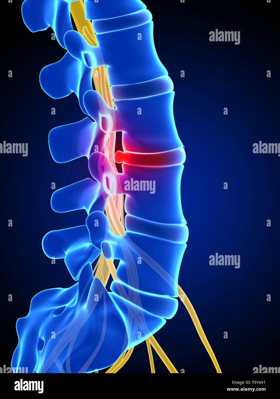 3d rendered illustration - herniated disk Stock Photo - Alamy