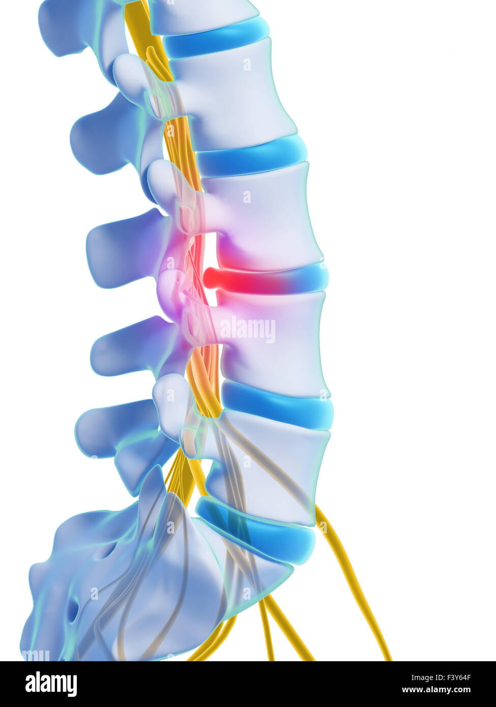 3d rendered illustration - herniated disk Stock Photo - Alamy