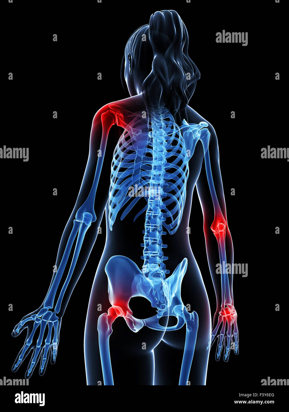 Inflamed joints hi-res stock photography and images - Alamy