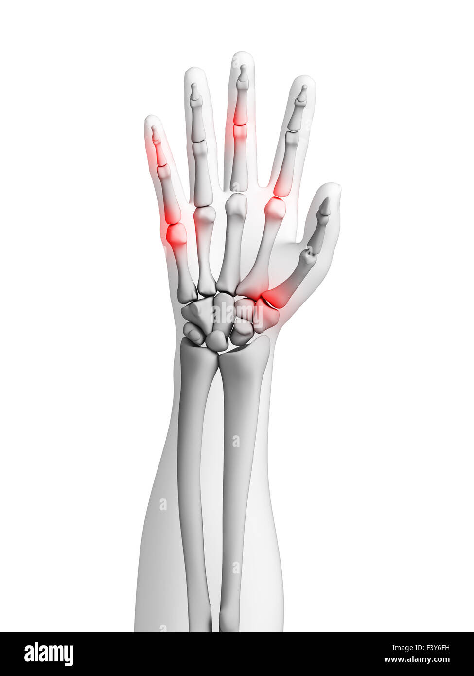 3d rendered illustration - arthritis Stock Photo - Alamy
