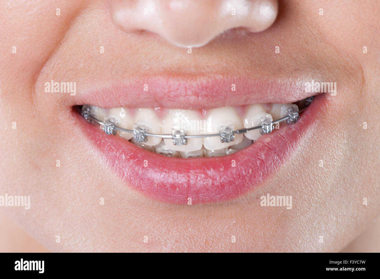 teeth with braces, close up Stock Photo - Alamy