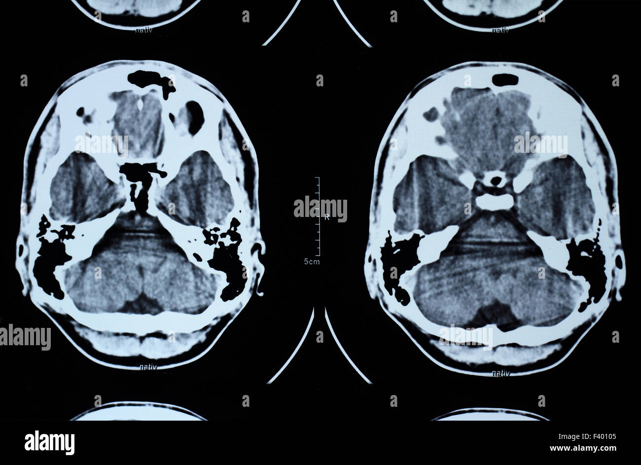 Photo of the CT and MRI of the skull Stock Photo - Alamy