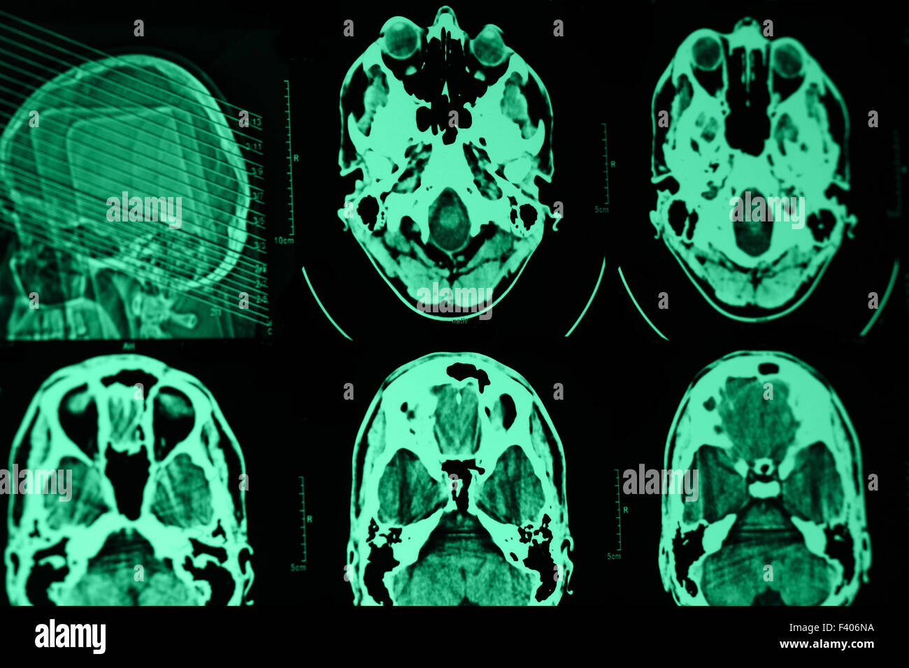 Photo of the CT and MRI of the skull Stock Photo - Alamy