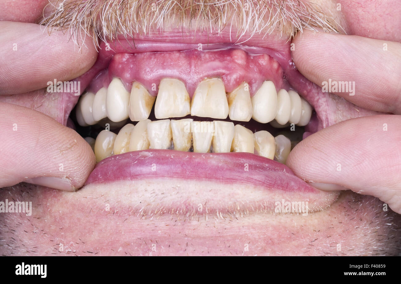 Problems with the teeth and gums Stock Photo - Alamy