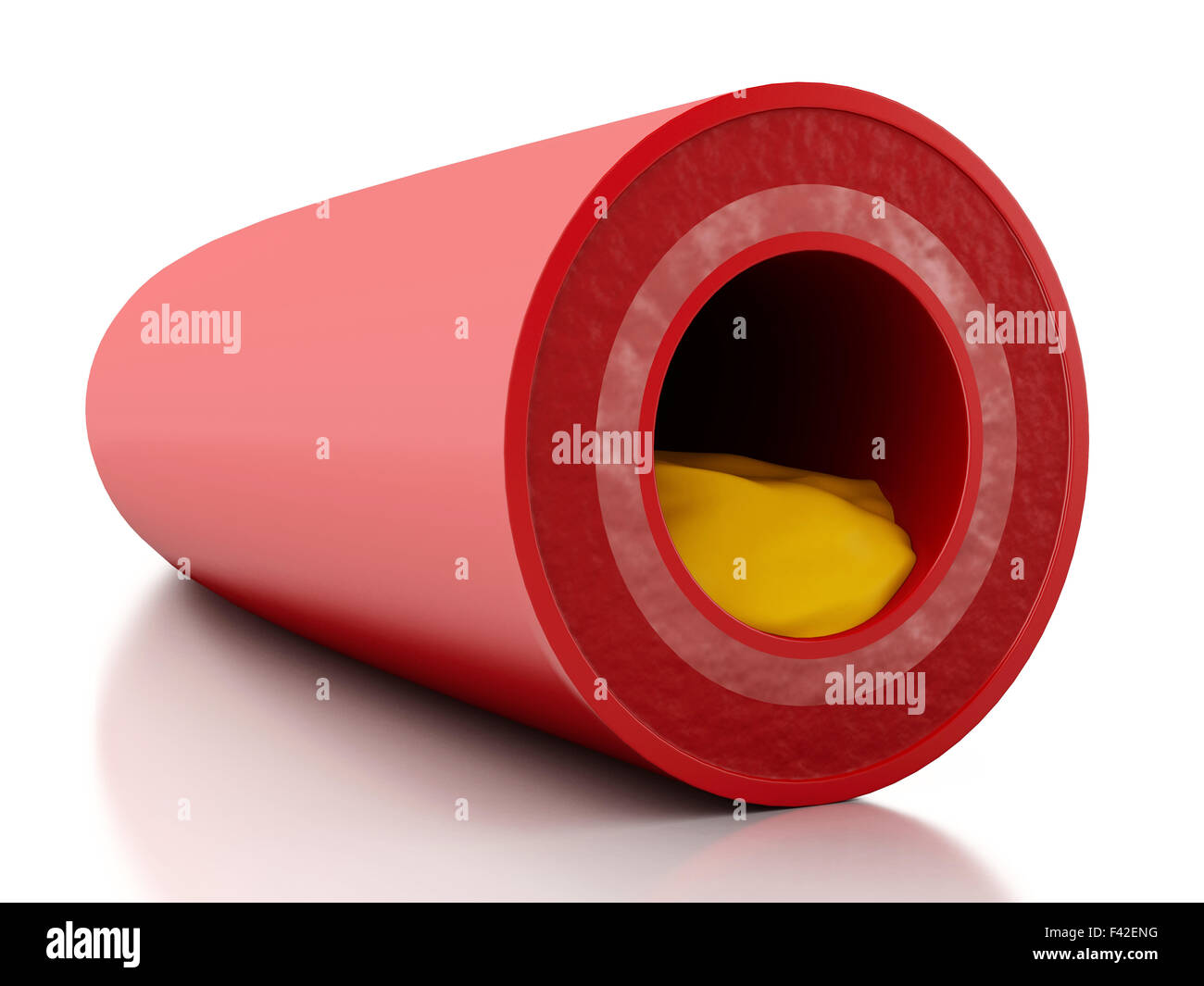 Artery plaque hi-res stock photography and images - Alamy