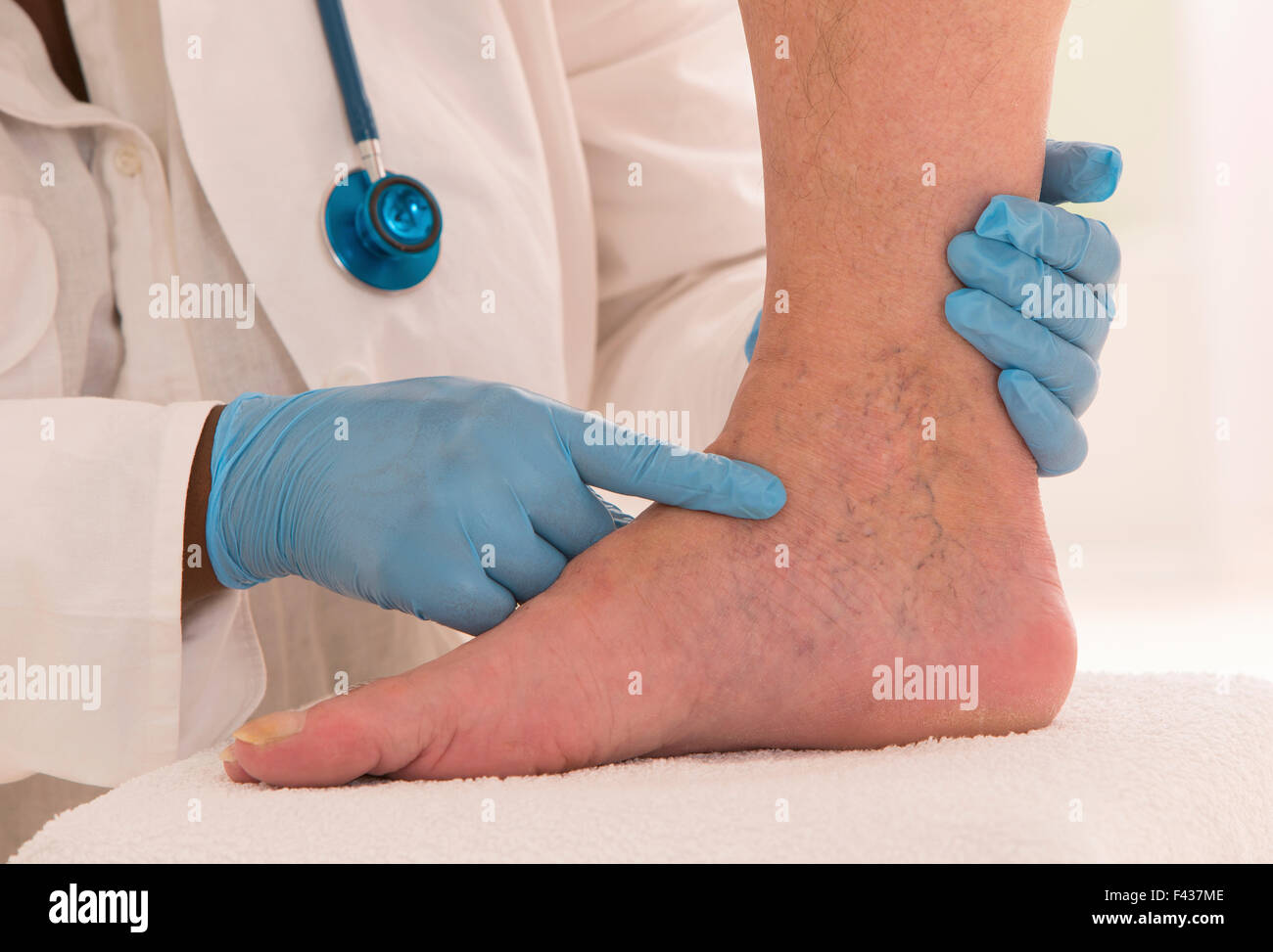 Varicose vein hi-res stock photography and images - Alamy