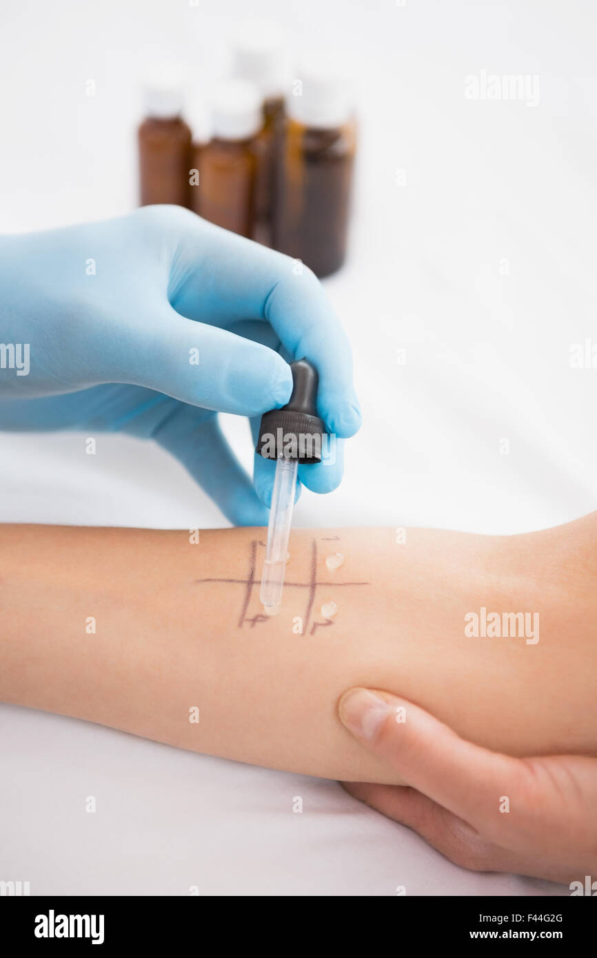 Doctor doing skin prick test at his patient Stock Photo - Alamy