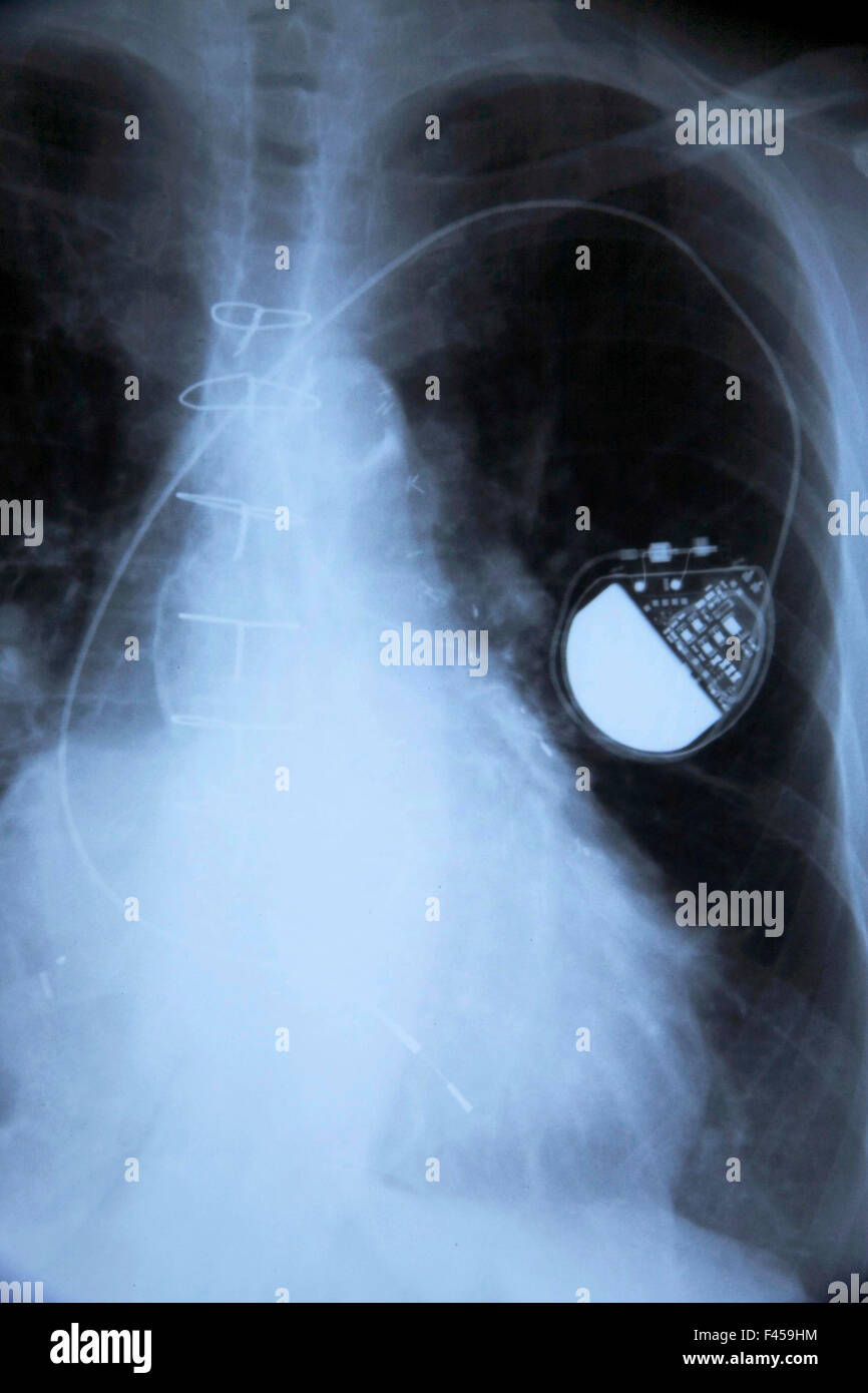 A chest X-ray of a 75-year-old man shows a pacemaker in place. Note the ...