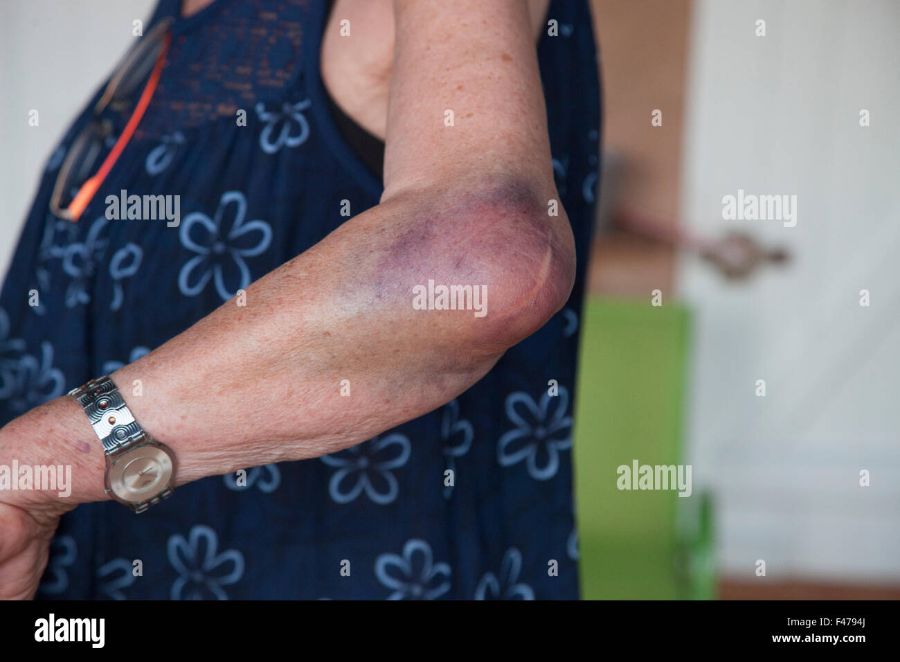 Hematoma arm hi-res stock photography and images - Alamy