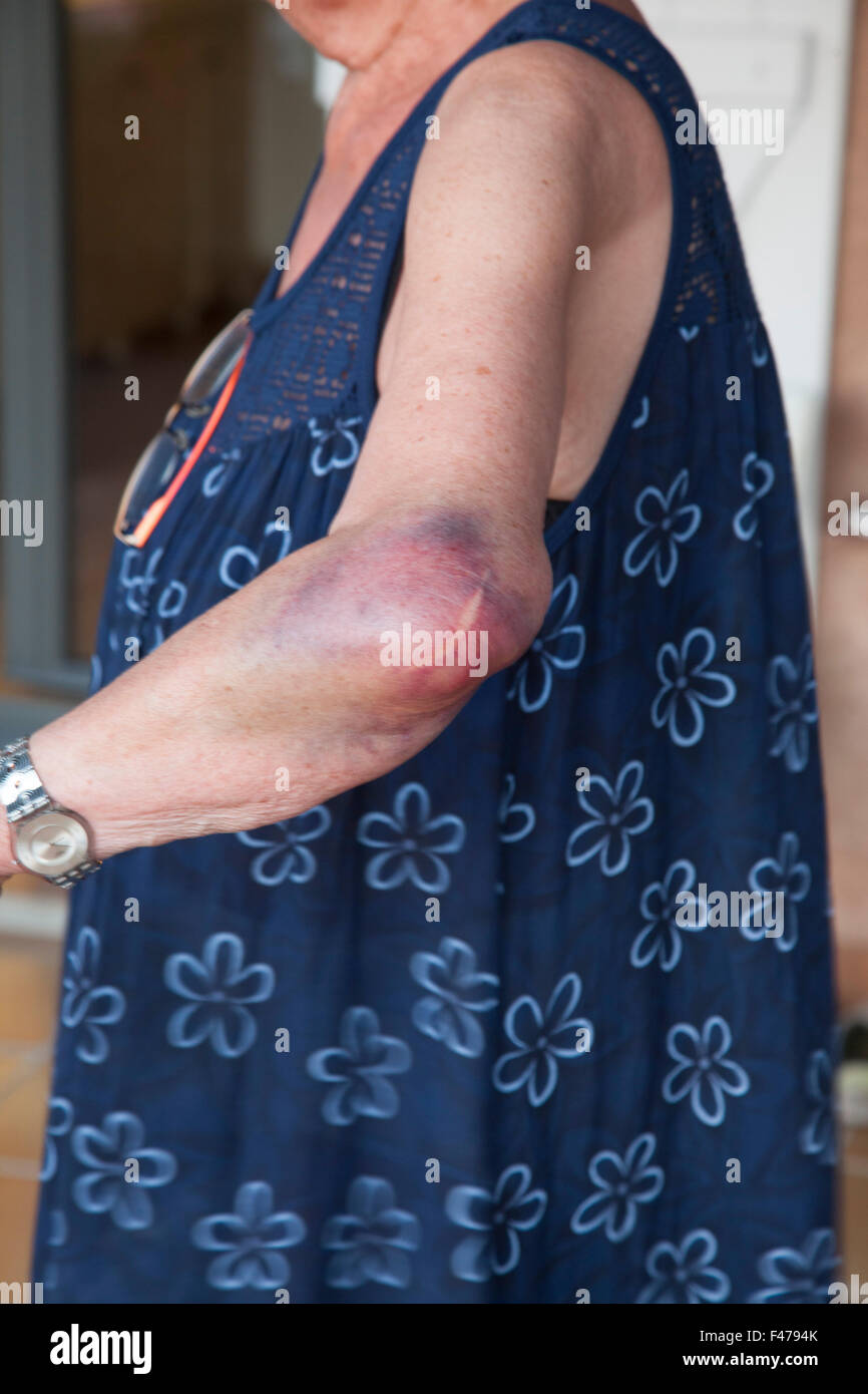 Hematoma arm hi-res stock photography and images - Alamy