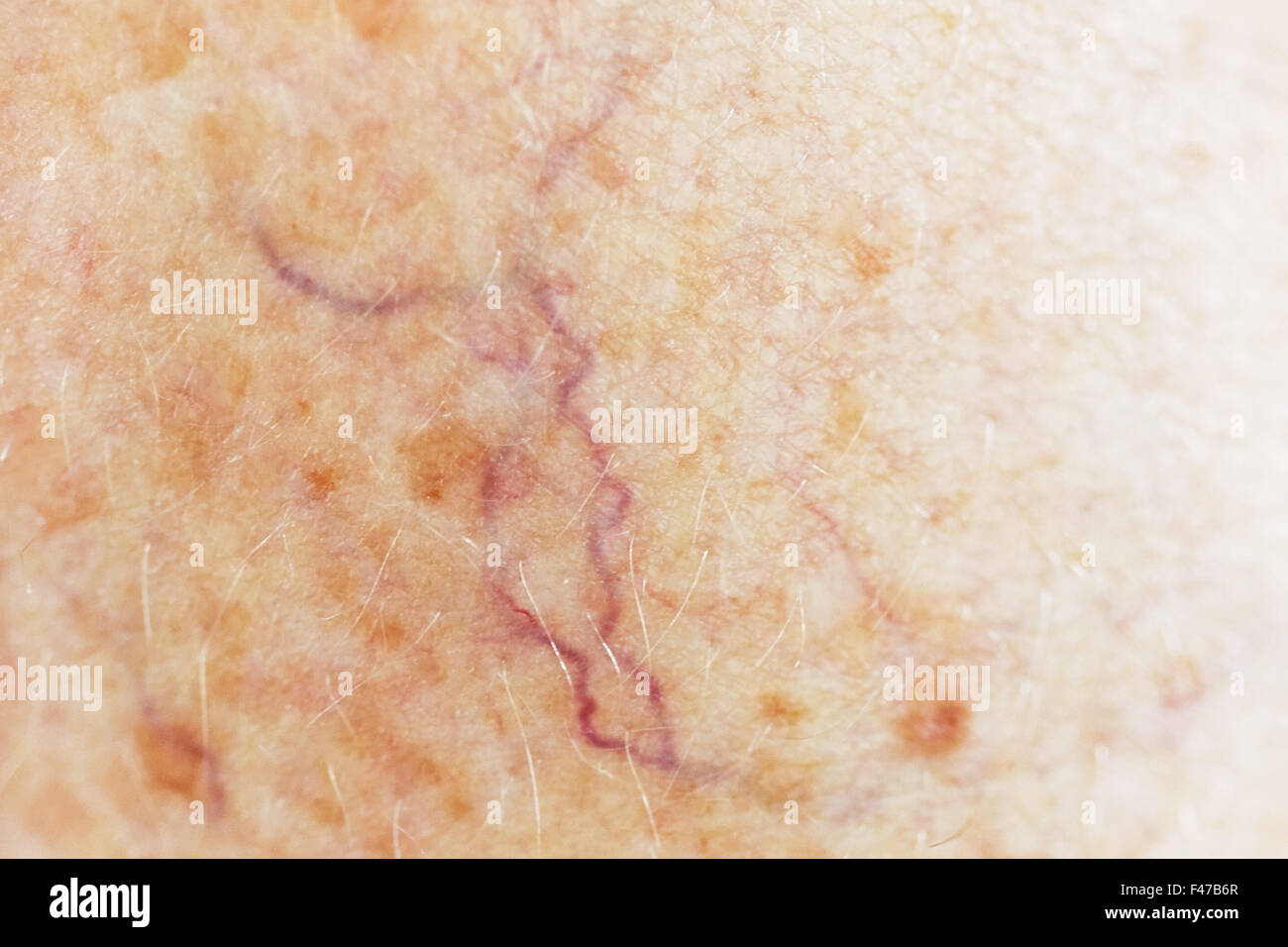 Telangiectasia hi-res stock photography and images - Alamy