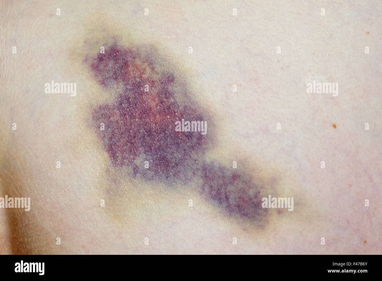 Bruise skin hi-res stock photography and images - Alamy