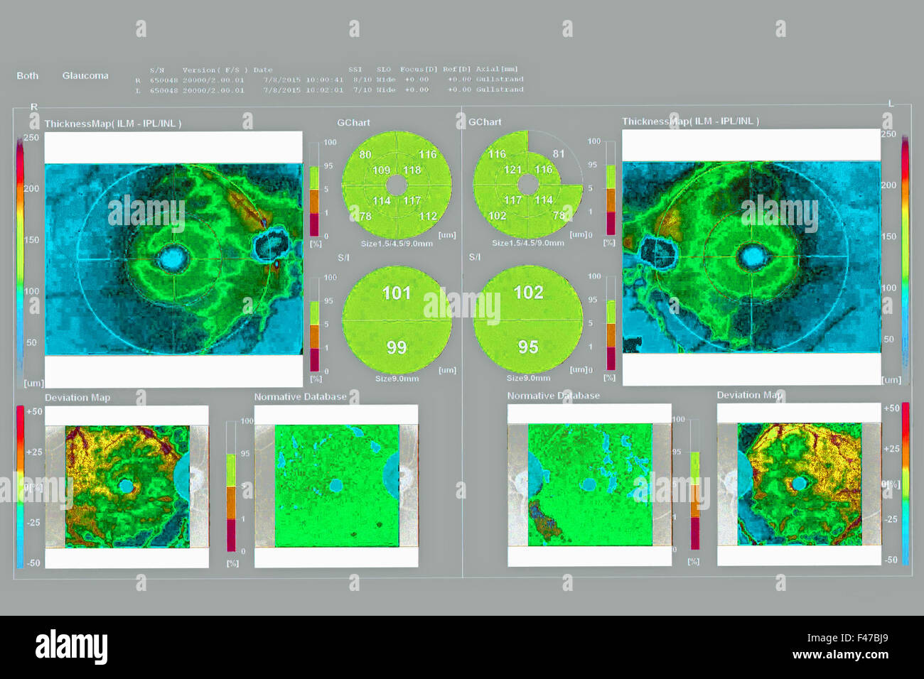 OPTICAL COHERENCE TOMOGRAPHY Stock Photo - Alamy